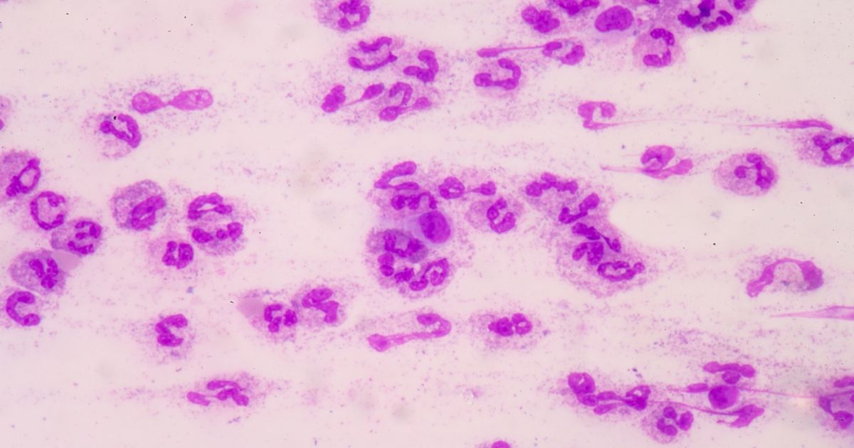 Mologic Developing Sepsis Test Using Multimarker Lateral Flow ...