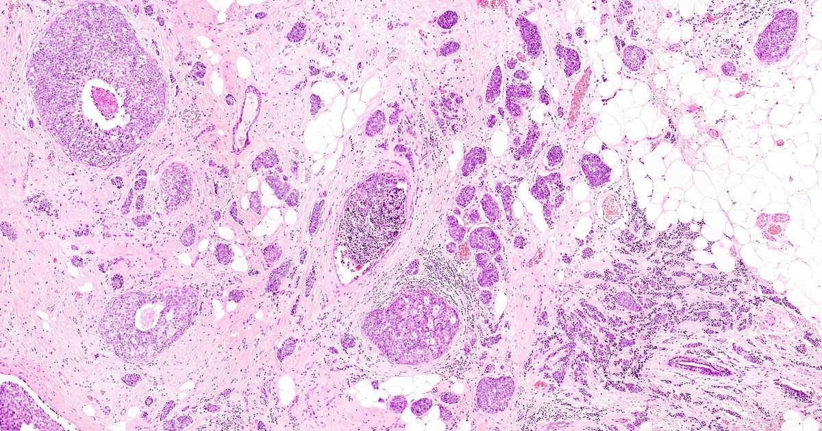 PreludeDx Builds Evidence for DCIS Test With Presentation at SABCS | 360Dx