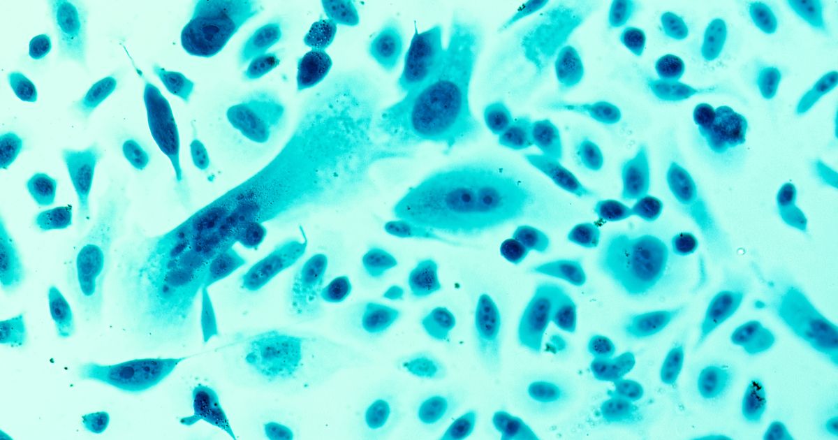 Myriad Genetics AI-Enhanced Prostate Cancer Test Aims to Improve Active ...
